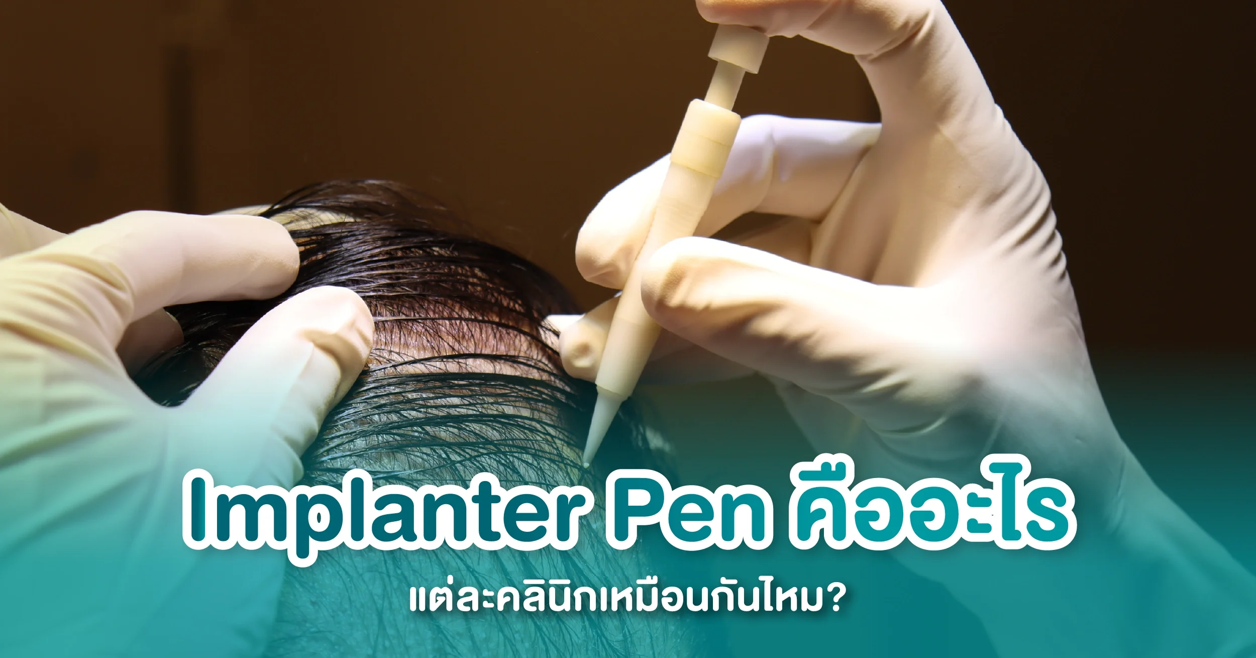 Implanter Pen คืออะไร? ปากกาปลูกผม DHI Technique