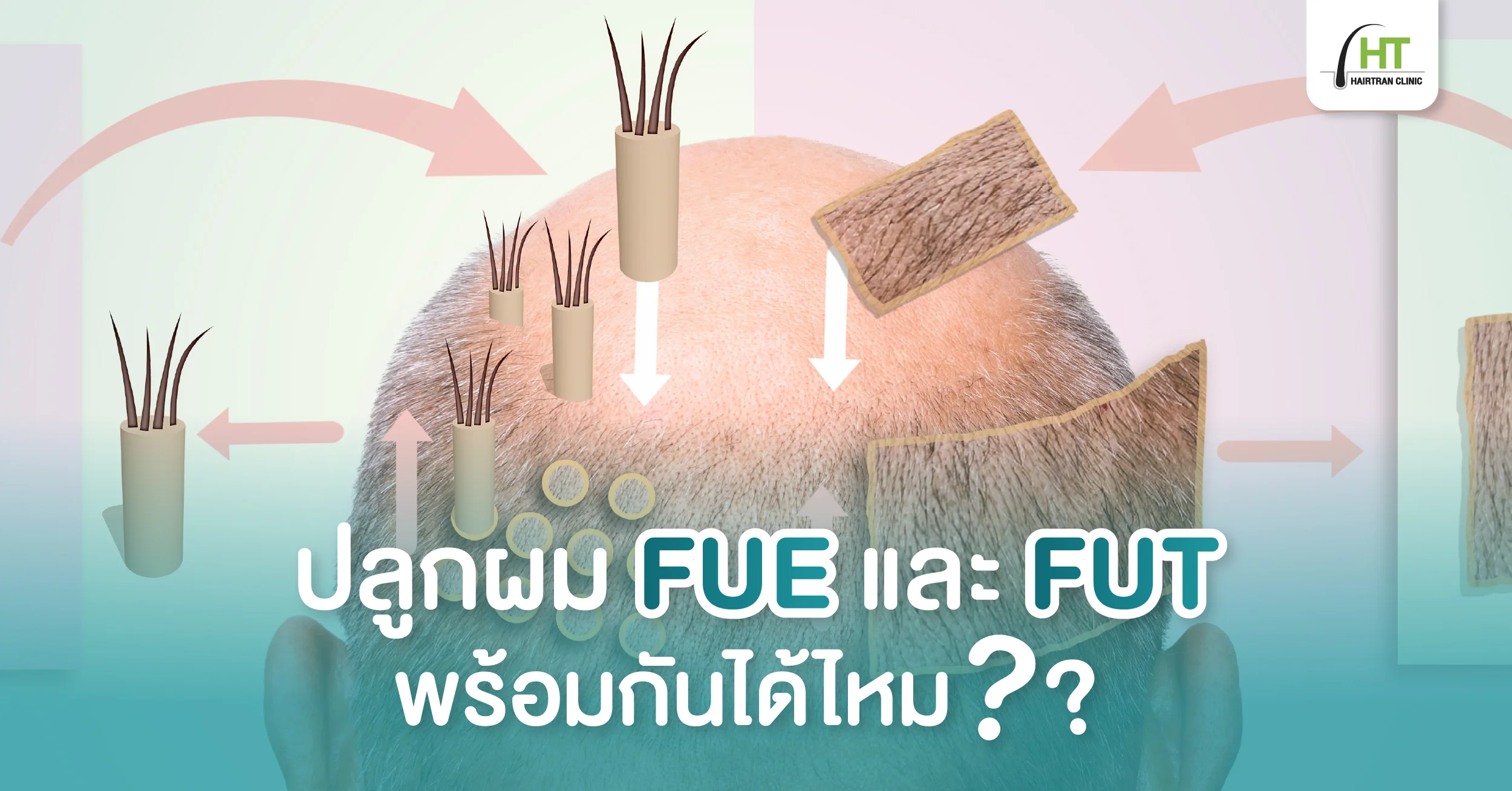 ปลูกผม FUE และ FUT พร้อมกันได้ไหม? แล้วเหมาะกับใครบ้าง